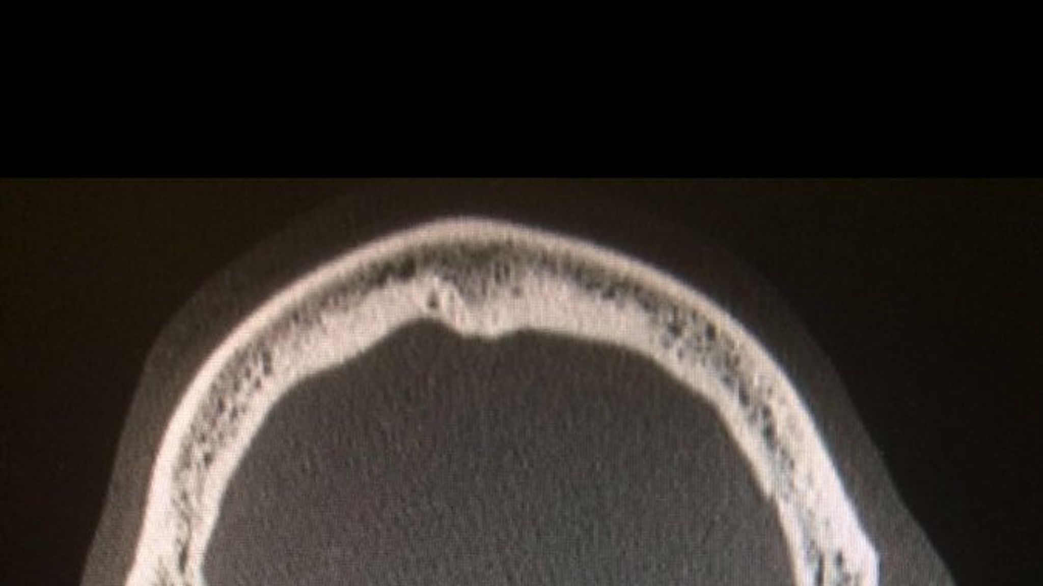 Golovkin vs Brook: Kell Brook to undergo surgery on broken eye socket ...