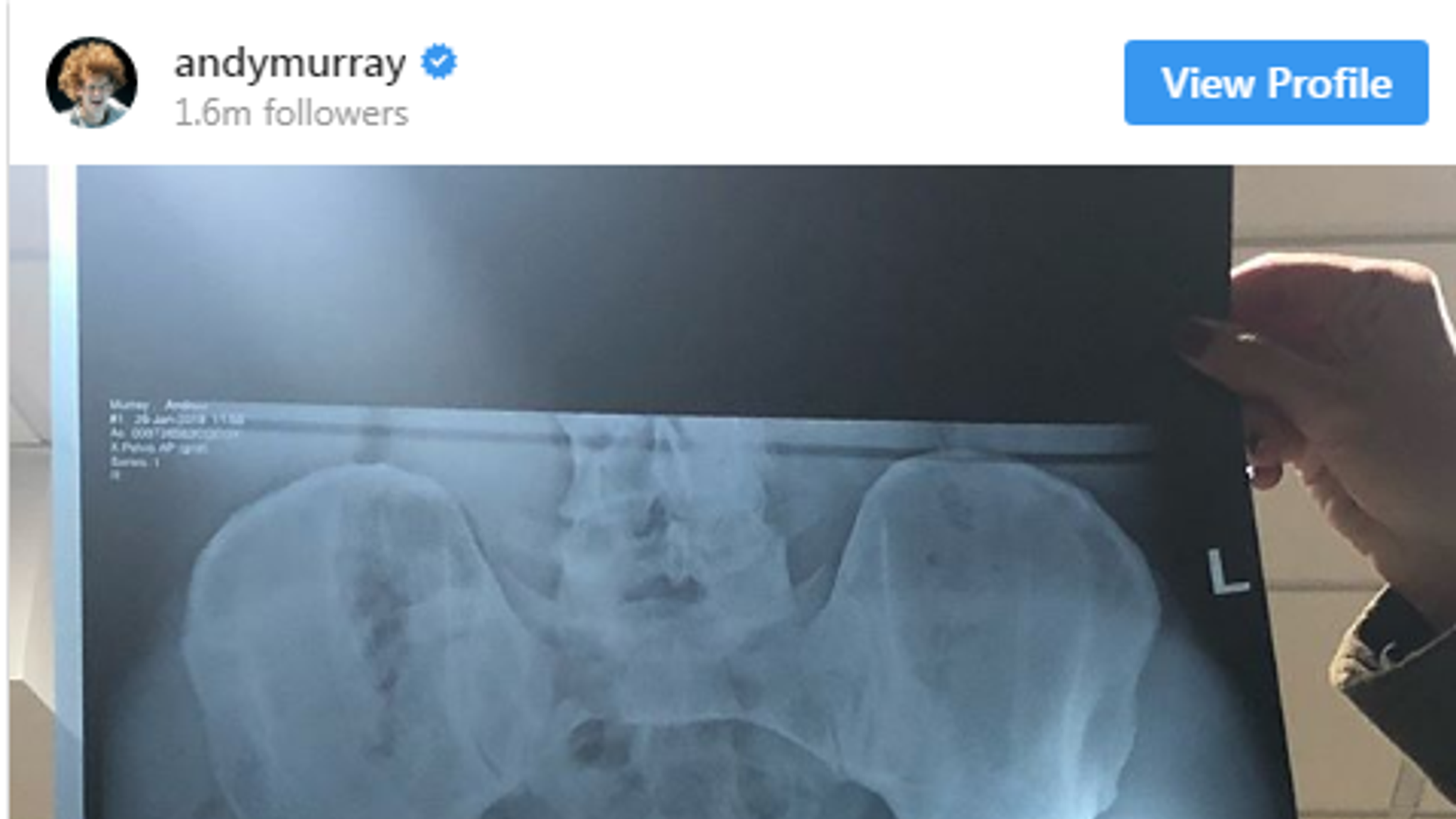 Andy Murray could be set to prolong his career following hip surgery ...