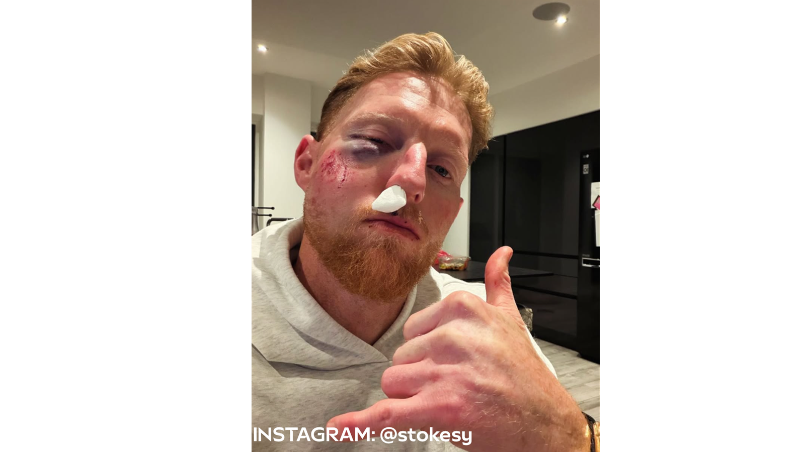 Ben Stokes left with facial injuries after being struck by cricket ball ...