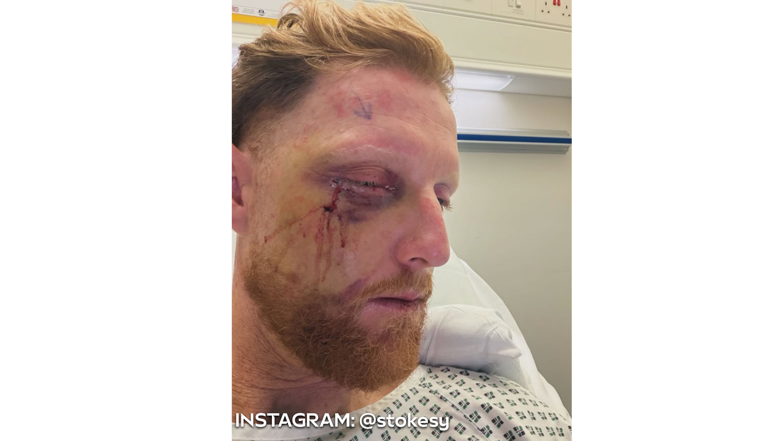 Ben Stokes: England Test captain undergoes successful surgery on eye ...